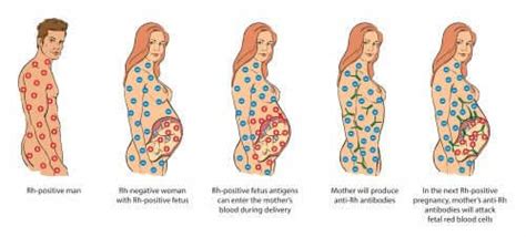 Rh Incompatibility During Pregnancy What You Need To Know
