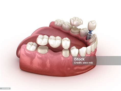 임플란트 크라운과 다리로 치아 회복 의학적으로 정확한 3d 일러스트 치과 개념 개념에 대한 스톡 사진 및 기타 이미지 개념 건강관리와 의술 도예 Istock