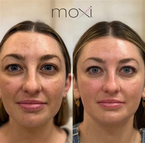 Unveiling The Ultimate Glow How Sciton BBL And Moxi Laser Work Together For Maximum Skin