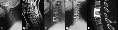 A 43 Year Old Patient Of Bilateral C5 6 Facet Dislocation Whose Plics Download Scientific