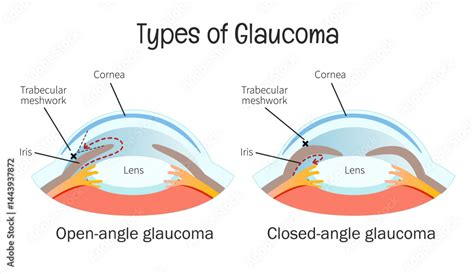 Vector Medical Poster Types Of Glaucoma Open Angle And Closed Angle Glaucoma On Eye Anatomy