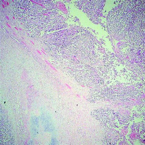 Malignant Melanoma Of Soft Tissueclear Cell Sarcoma Download