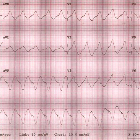 A 12 Lead Electrocardiogram That Demonstrates A Wide Complex Rhythm
