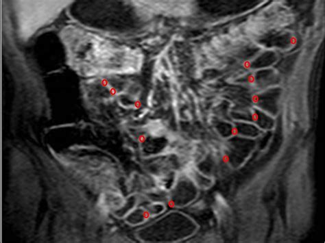 Assessment Of Small Bowel Wall Perfusion To Calculate Mri Perfusion Download Scientific