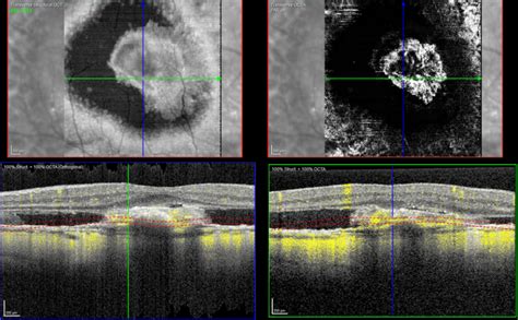 Oct Interpretation In Oct Angiography Gloucestershire Retinal