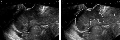 Uterine Cancer Ultrasound Images