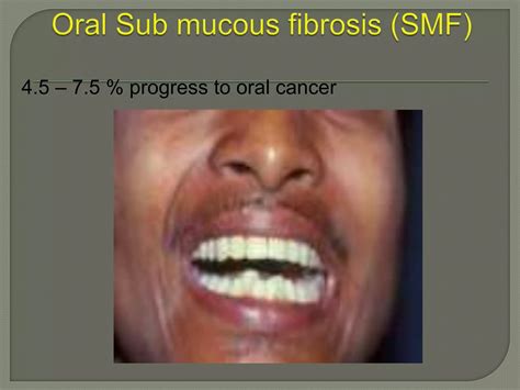Carcinoma Buccal Mucosa Pptx
