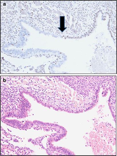 Representative Case Of A Non Atypical Endometriosis Lesion Adjacent To
