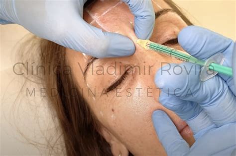 Eliminar Las Arrugas Del Entrecejo Dr Vladimir Rovira