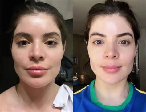 Gkay Existe Forma Segura De Retirar O Preenchimento Facial Como Fez A