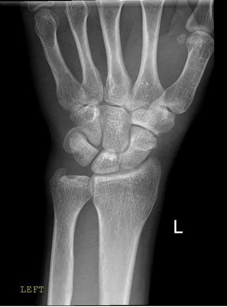 Scaphoid Fracture X Ray