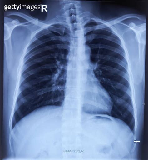 Cxr Chest X Ray Pa View Normal Findings 이미지 1864095128 게티이미지뱅크