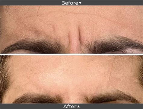 Botox Before And After Pictures In Los Angeles Assil Gaur Eye Institute