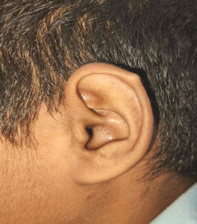 Prominent Darwins Tubercle Located At The Posterosuperior Aspect Of