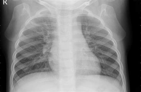 Azraahmadi Autotrain Data Xray Dataset · Datasets At Hugging Face