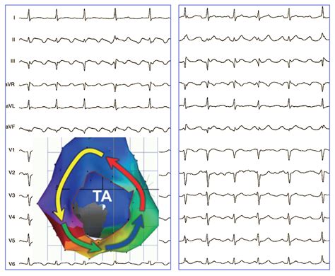 Causas Y Tratamiento Del Flutter Auricular Instituto De Arritmias