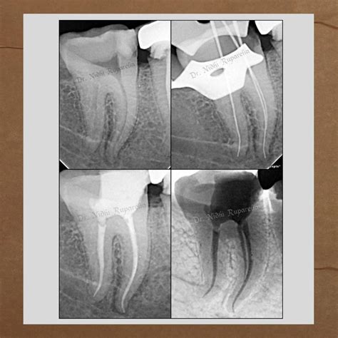 Dr Nidhi Ruparelia On Linkedin Soffit Preservation Dentistry Is All