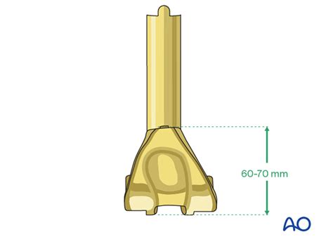 Distal Femoral Replacement For Fracture Around A Loose Femoral