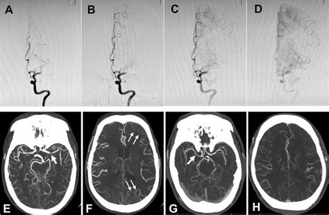 Cerebral Collaterals In Icad Shown In Dsa And Cta Images A D Dsa