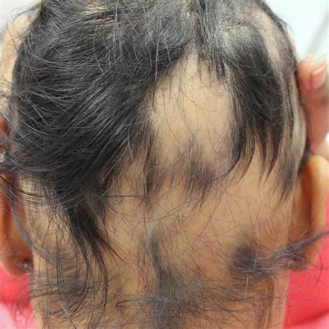 Smp For Alopecia Perth Smp Wa