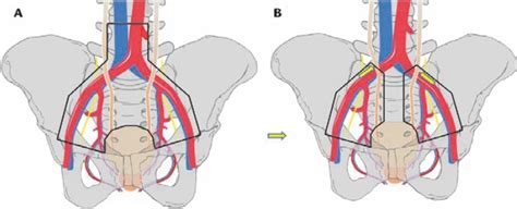 Extent Of Pelvic Lymph Node Dissection During Radical Cystectomy Is Bigger Better Pmc