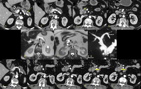 Each Row Includes A Different Patient With Probable BD IPMN With No