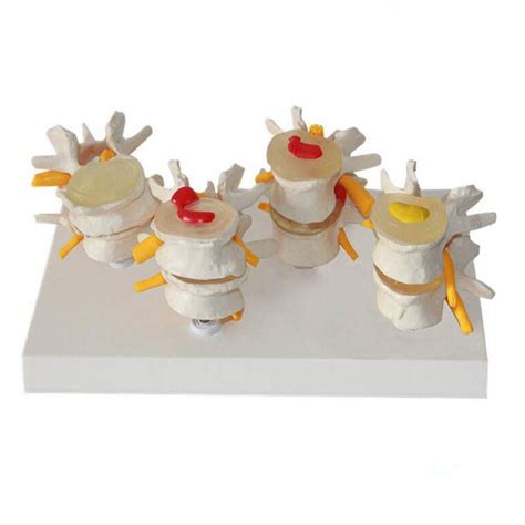 Buy Anatomy Model Assembly Lumbar Spine Diseased Model 4 Stage Human Lumbar Lesion Spine