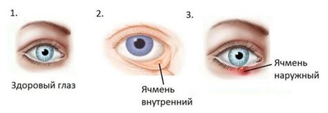 Ячмінь на оці ніж лікувати на нижньому верхньому столітті у дитини