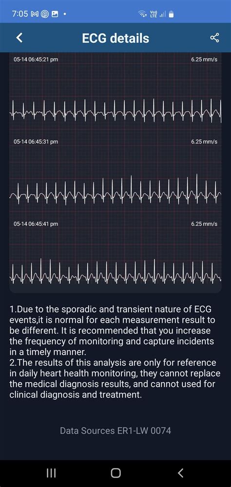 Is This Afib Svt Or Something Else Rafib