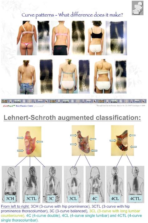 The Different Curve Patterns According To Lehnert Schroth Augmented