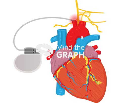 Free Vagus Nerve Stimulation Vns Icons Symbols Pictures And Images