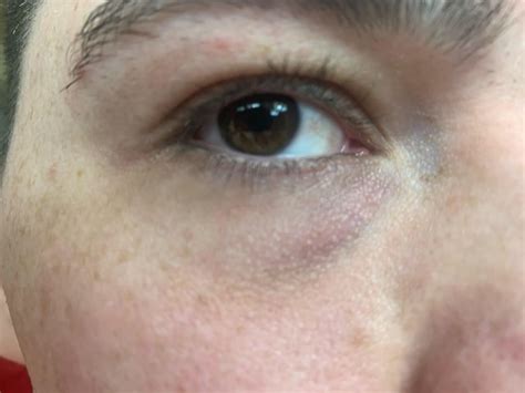 Is This Blepharitis R Blepharitis