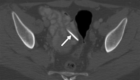 No Radiopaque Foreign Body At Patrick Lauzon Blog