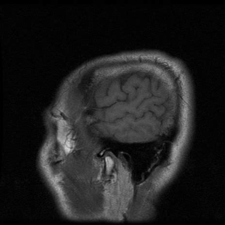 頭部TIPS症例20 MRI T1WI矢状断像