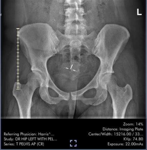 Iud Placement Rmedical