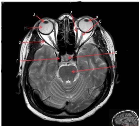 Axial Brain 4 Diagram Quizlet