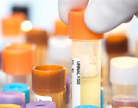 What Is A Urinalysis At Mary Wilmes Blog