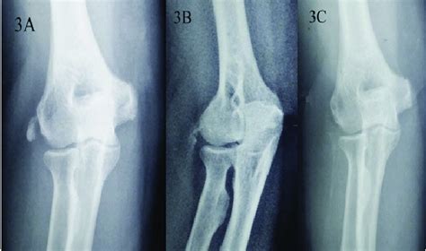 Sequential Antero Posterior Radiograph Of The Right Elbow A Initial
