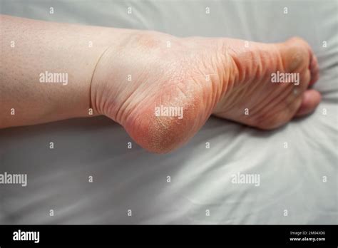 Sole Of Foot Cracking