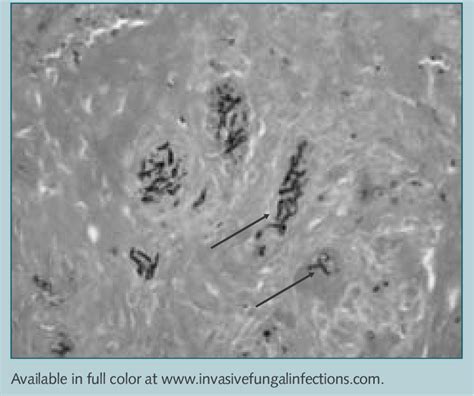 Melanin Stain Masson Fontana On A Brain Biopsy Shows Moniliform