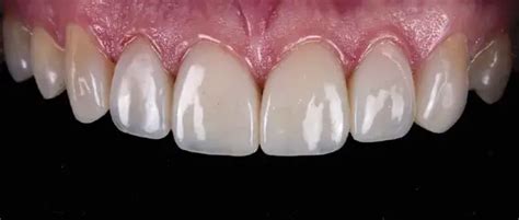 Direct Composite Veneers A Guide For Correct Layering Technique