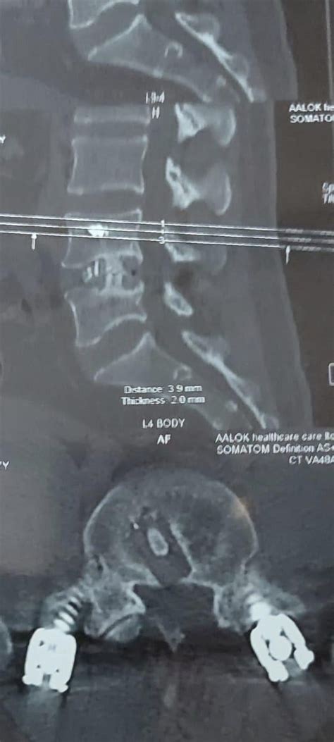 L4 5 Tlif Does It Look Like A Solid Fusion [15 Months Post Op Ct] R