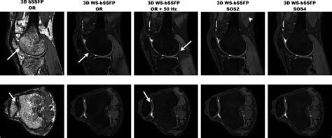3d Human Knee Images Acquired At 3t Using Standard Bssfp And Ws Bssfp