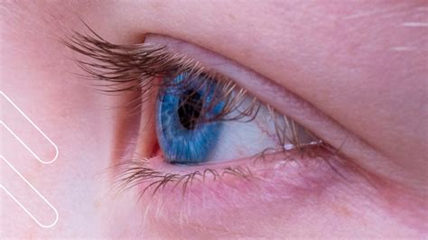 Sintomas De Glaucoma