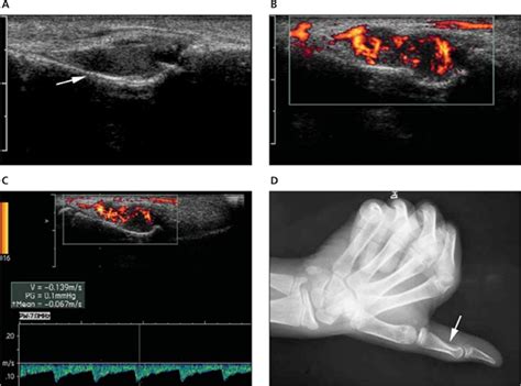 Giant Cell Tumor Of Tendon Sheath