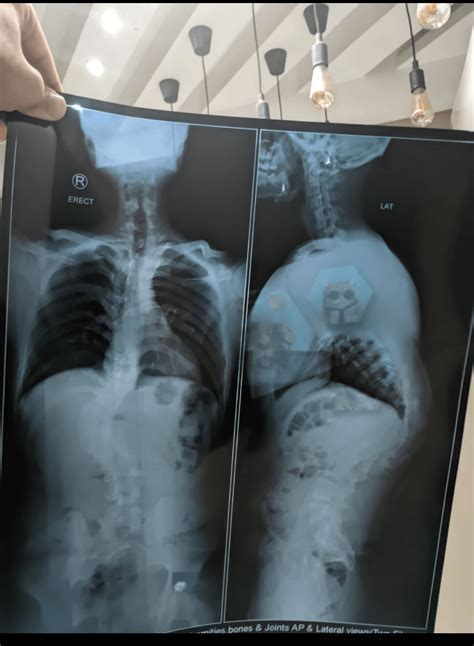 Kyphoscoliosis Rkyphosis