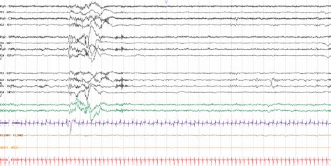 Normal Eeg Tracing