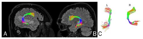 Arcuate Fasciculus Dti