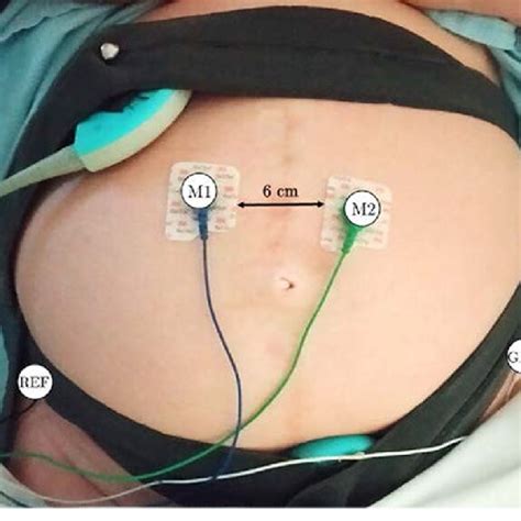 Electrodes Positioning For Uterine Myoelectrical Recording M1 Download Scientific Diagram