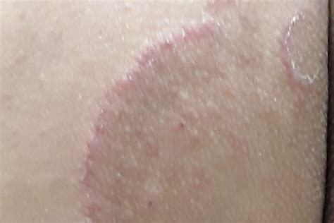 곰팡이 Deltaclinic
